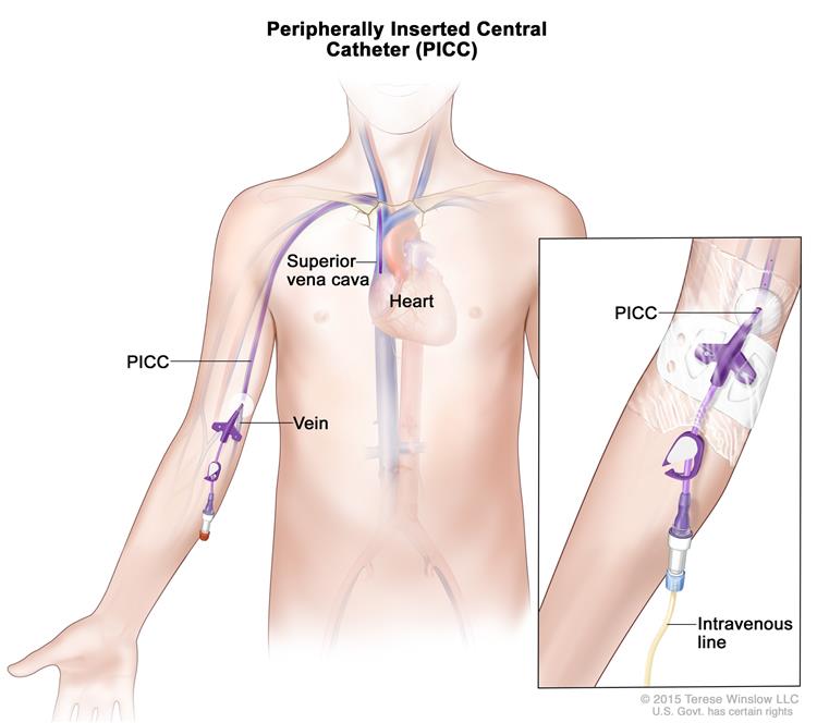 PICC Line Placement CPT Code Knowledge Center